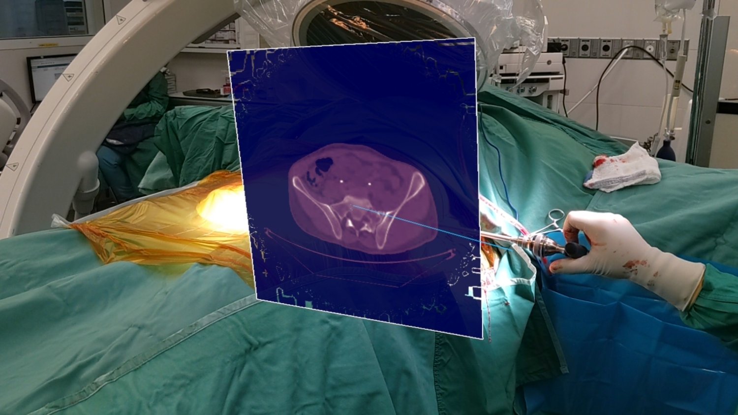 Novarad VisAR: Advancing Orthopedic Surgery with AR