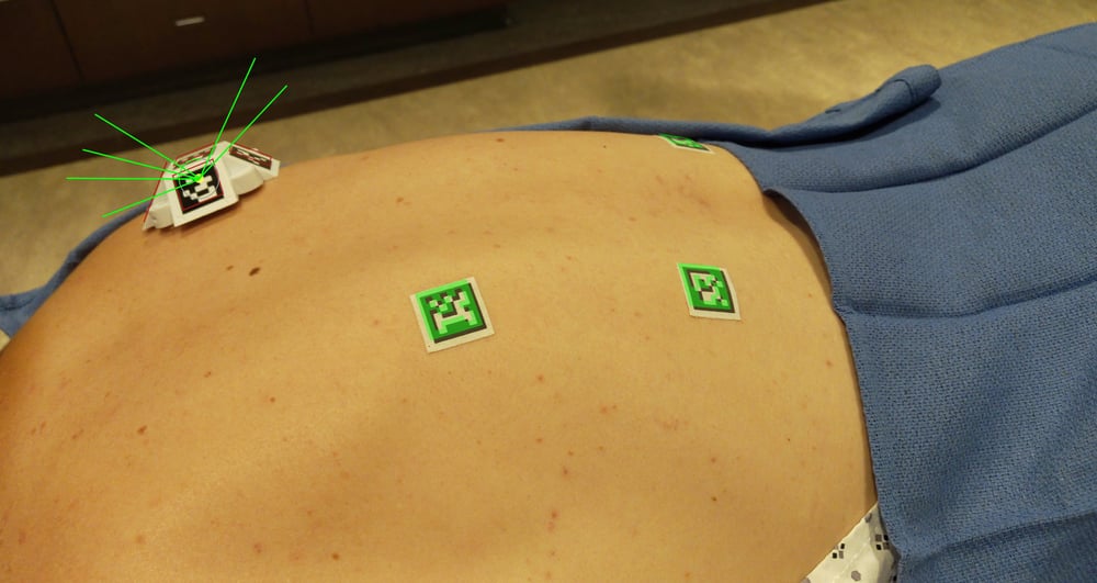 VisAR: Augmented Reality Surgical Navigation | Novarad
