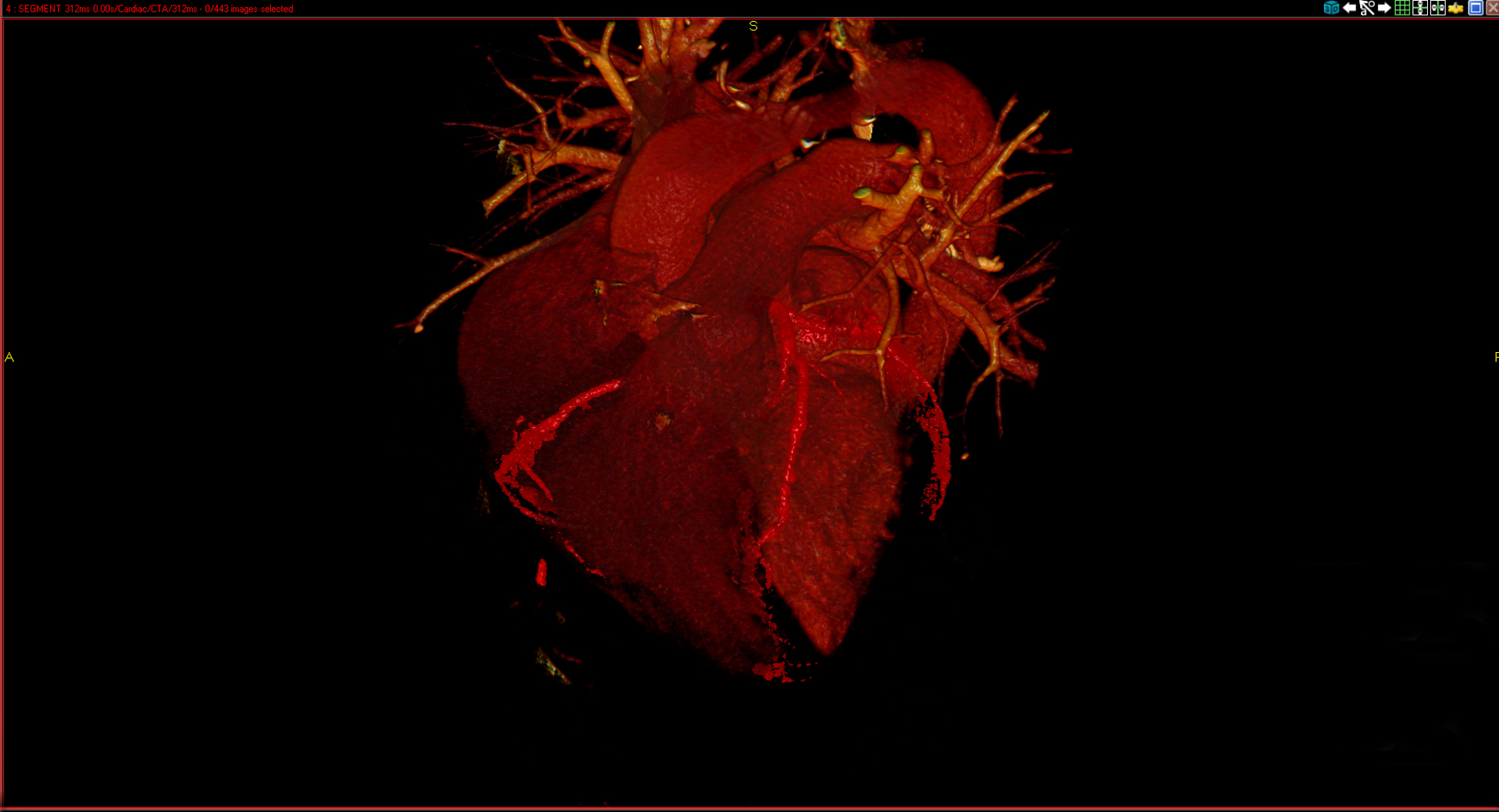 NovaCardio - Cardiac Motion Imaging CPACS Solution | Novarad