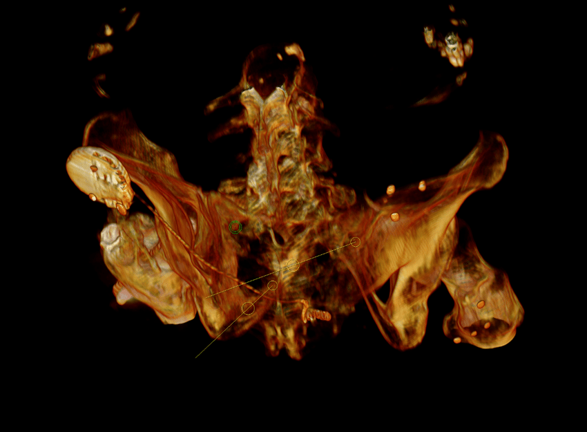 VisAR: Revolutionizing Interventional Radiology