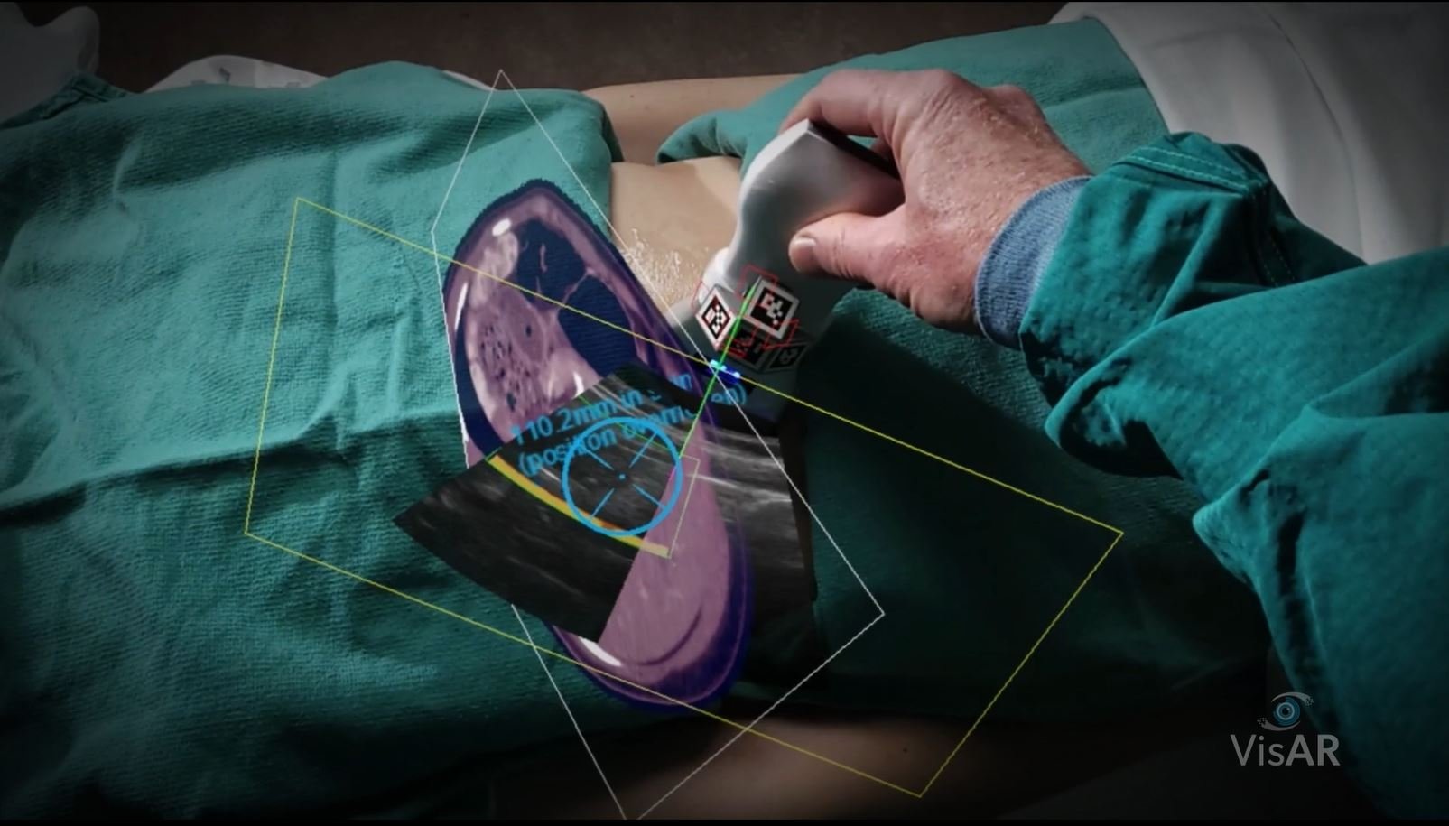 VisAR: Augmented Reality Surgical Navigation | Novarad