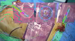 VisAR: Augmented Reality Surgical Navigation | Novarad