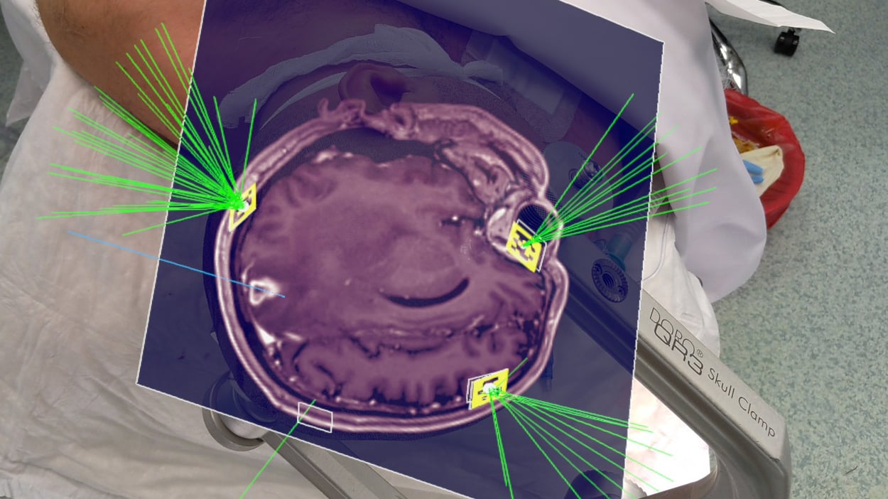 VisAR: Pioneering AR Neurosurgical Navigation