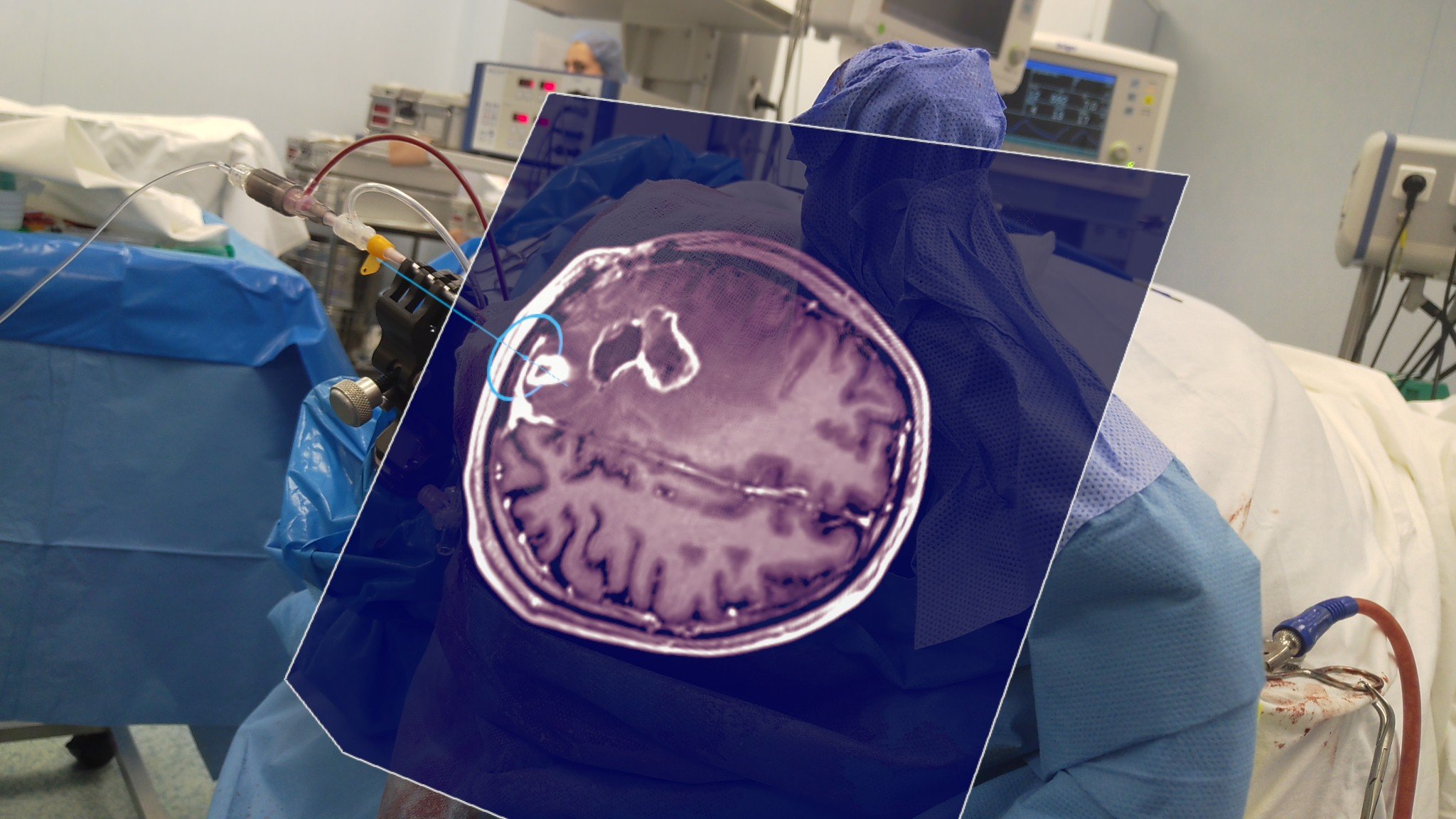 VisAR: Pioneering AR Neurosurgical Navigation